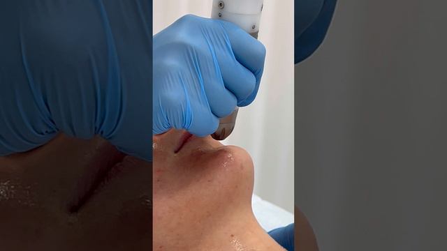 БЕЗИНЪЕКЦИОННАЯ МЕЗОТЕРАПИЯ DERMADROP