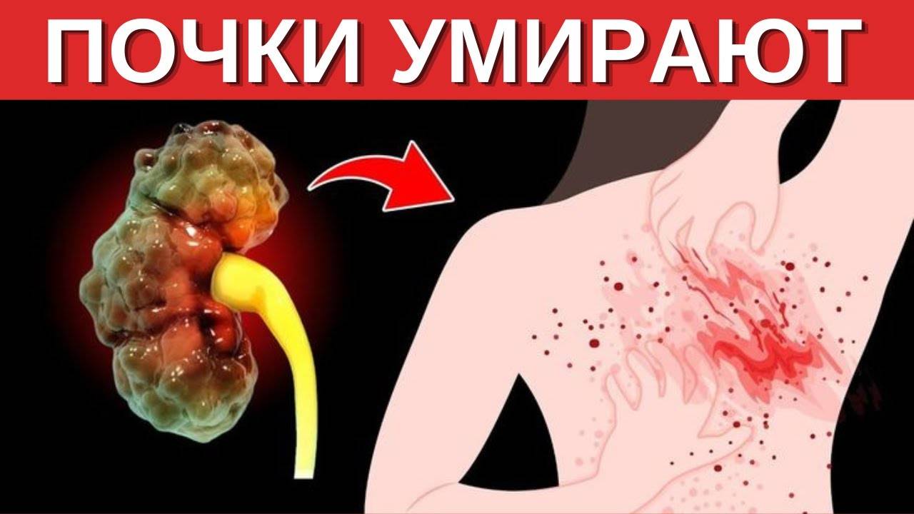 ПРИЗНАКИ ТОГО, ЧТО ВАШИ ПОЧКИ УМИРАЮТ!