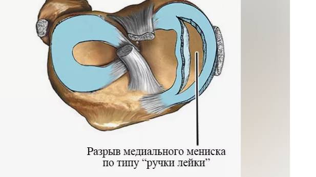 Повреждение мениска по типу ″ручка лейки