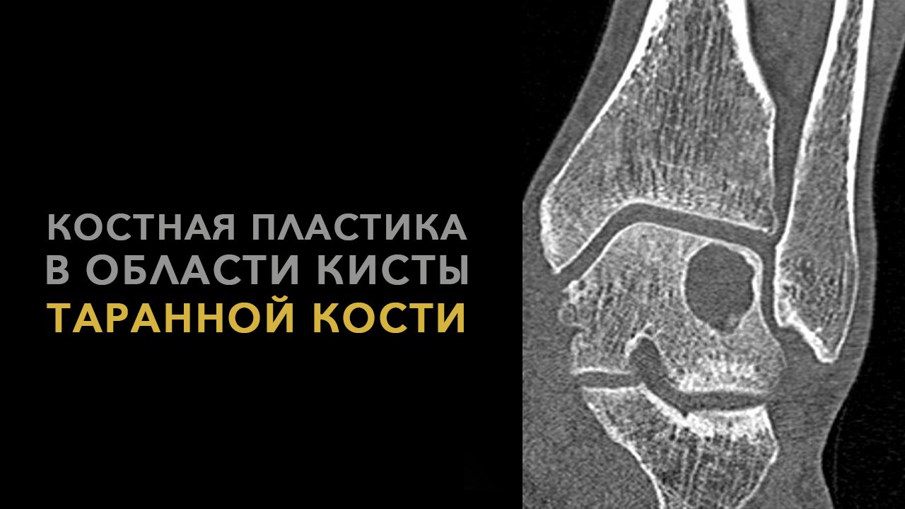 Травмы стопы и голеностопного сустава – смотреть онлайн все 4 видео от  Травмы стопы и голеностопного сустава в хорошем качестве на RUTUBE