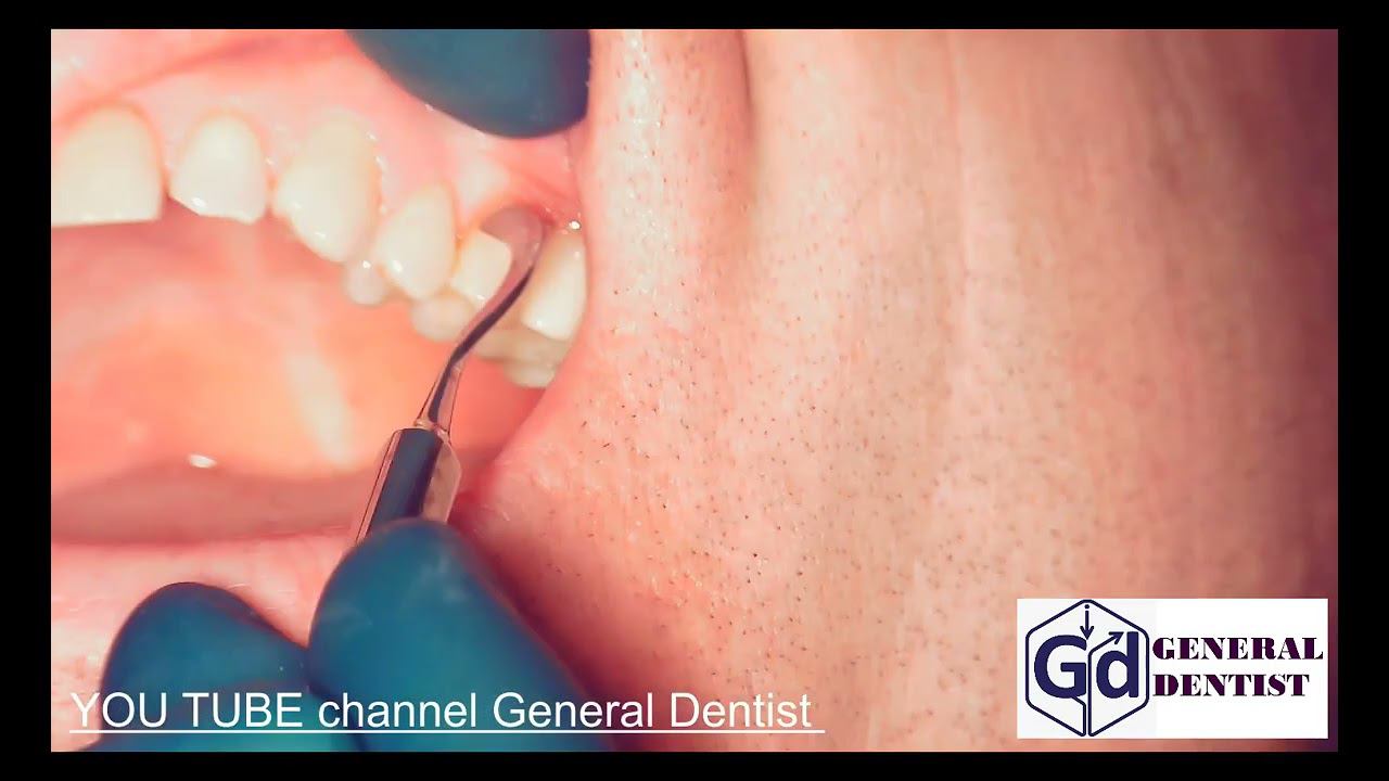 Extraction teeth