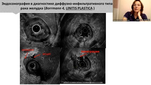 Эндоскопическая диагностика в онкологии