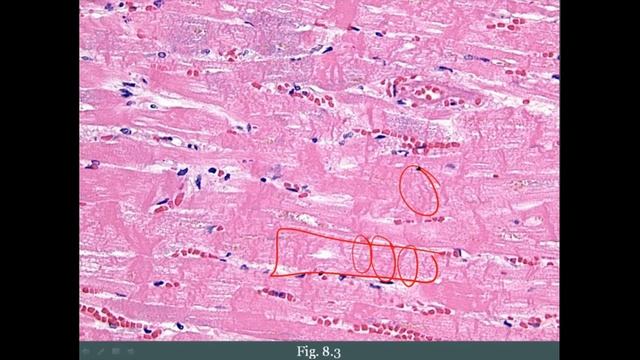 8/19 - Pathoma USMLE (2022): Сердечная патология