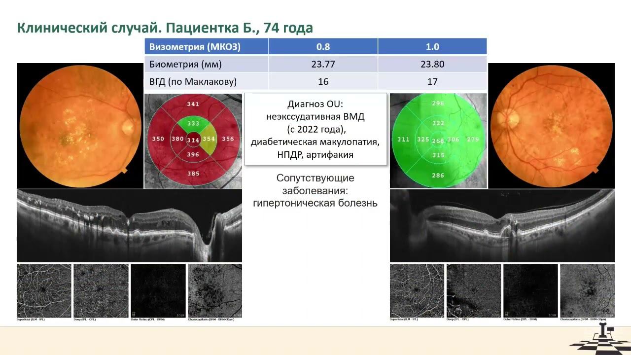 Cателлитный симпозиум«Королевский гамбит. Нетепловая репаративная терапия сетчатки при ВМД лазером 2