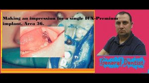 Impression for implants